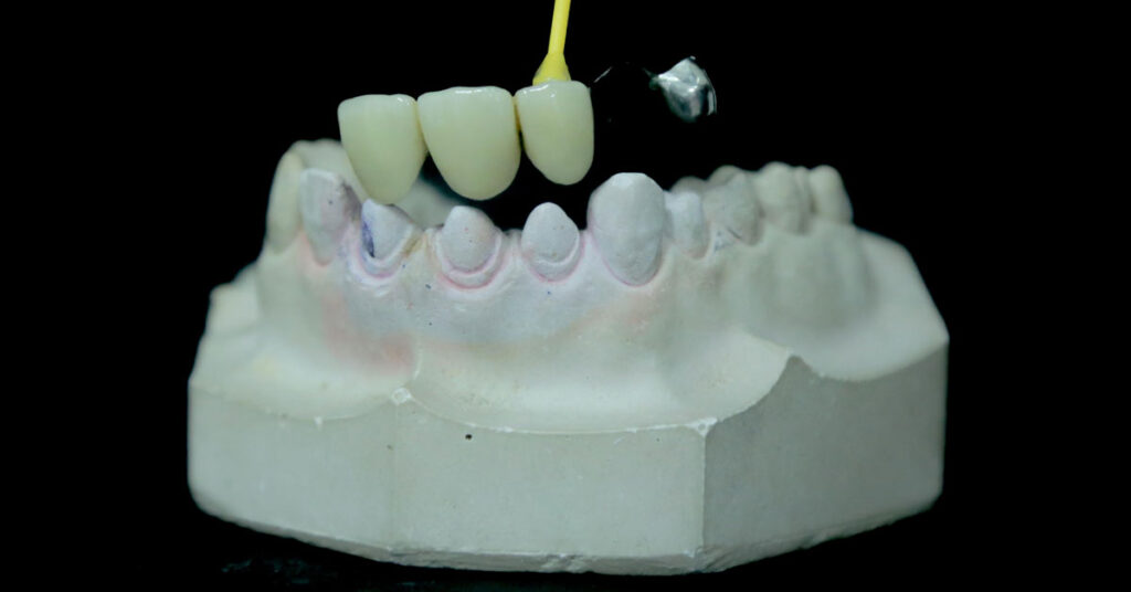Apa Itu Gigi Palsu Lepasan? Jenis, Manfaat dan Cara Merawatnya!